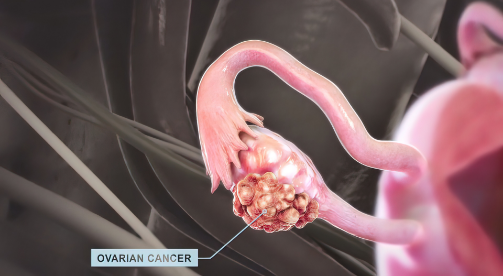 Ovarian Cancer Symptoms Causes Stages And Treatment In Malaysia Sjmc